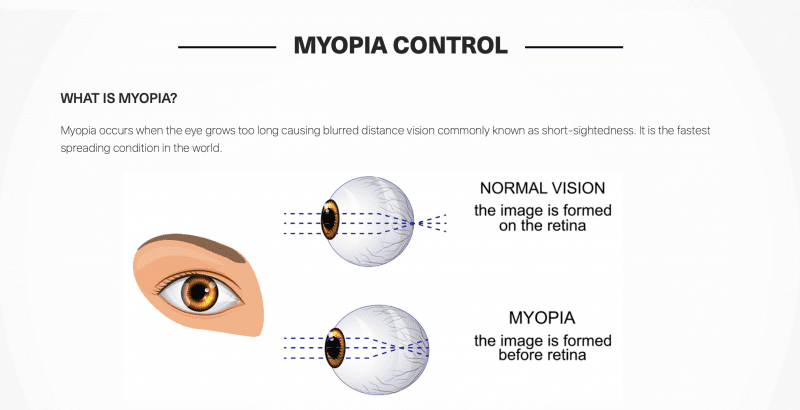 Myopia control lenses for children with advancing short sightedness