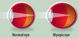 MiyoSmart - Myopia Control Lenses for Children » OpticalRooms