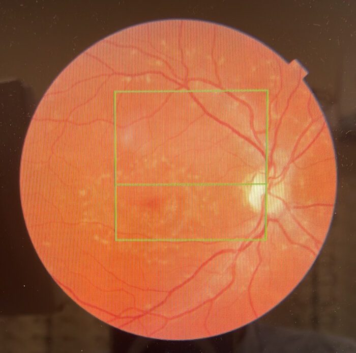 Understanding the Link Between High Cholesterol and Retinal Health: The ...